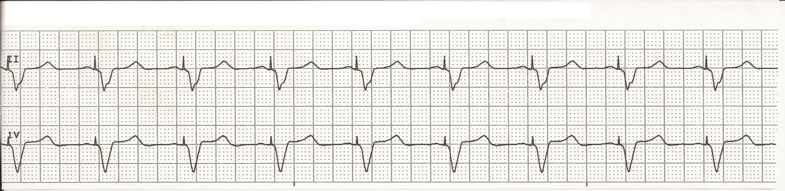 EKG Rhythm Strips 23: Paced Rhythms