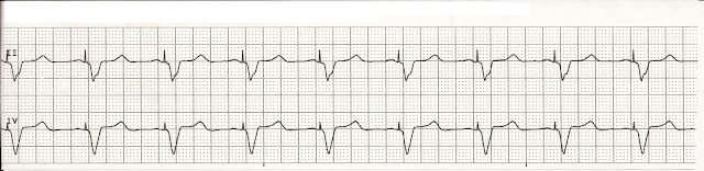 Float Nurse: EKG Rhythm Strips 23: Paced Rhythms