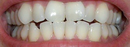 Sneek's Invisalign Treatment: Progress - Before Invisalign
