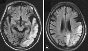 Medical Treatment Pictures-for Better Understanding: MERRF Syndrome