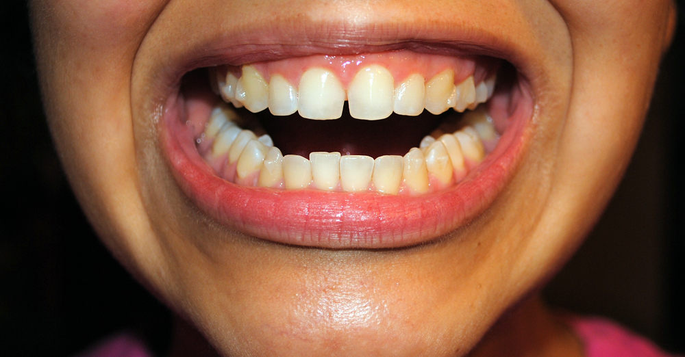 My Life with Invisalign: Week 4 and Week 5