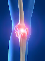 LESIONES DEPORTIVAS: Lesión del ligamento lateral externo