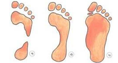 EL PIE PLANO Y SUS VARIABLES