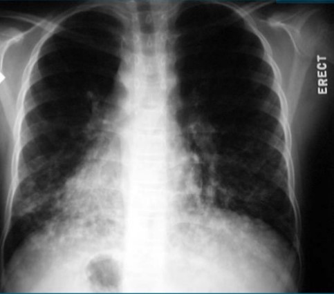 ESTRATEGIAS DE INTERVENCIÓN CARDIOPULMONAR : PRUEBAS DE FUNCIÓN PULMONAR