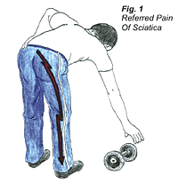 Physical Therapy DataBase: Sciatica - Part I