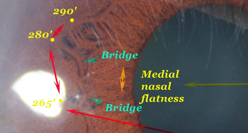 Modern & Multidimensional Iridology: The Correlation of Iris Signs ...