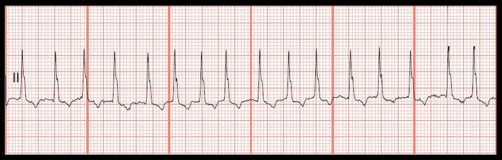 Practice Rhythm Strips 255