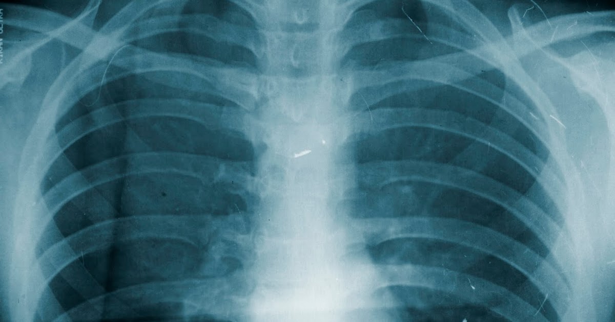 KOL - kronisk obstruktiv lungesygdom: Patofysiologi