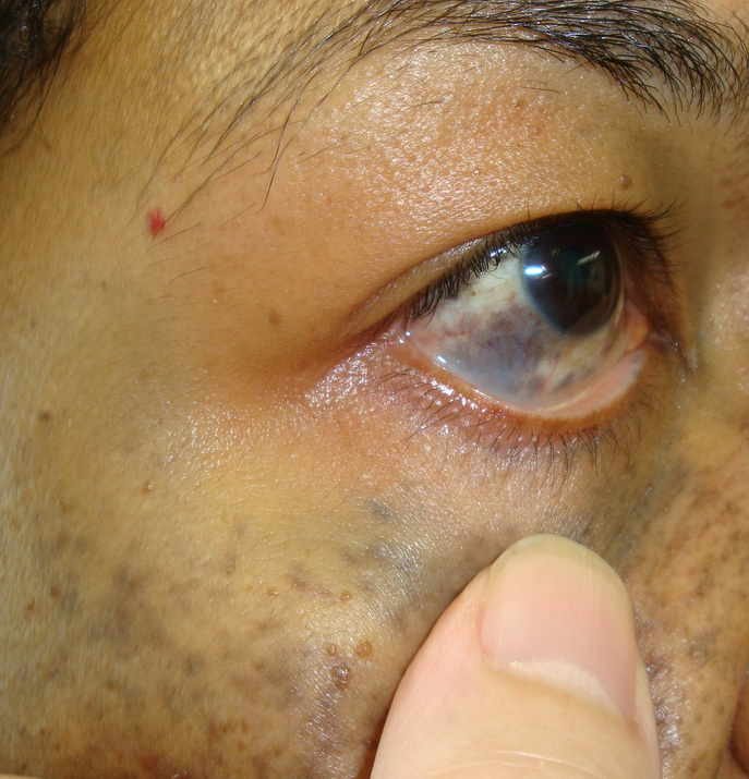 Dermpath Made Simple - Neoplastic: Benign Pigmented Lesions - Solar ...