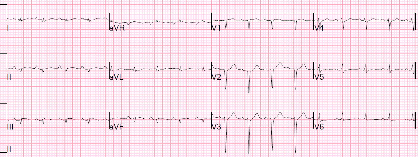 Dr. Smith's ECG Blog: Very young man with chest pain, then cardiac arrest