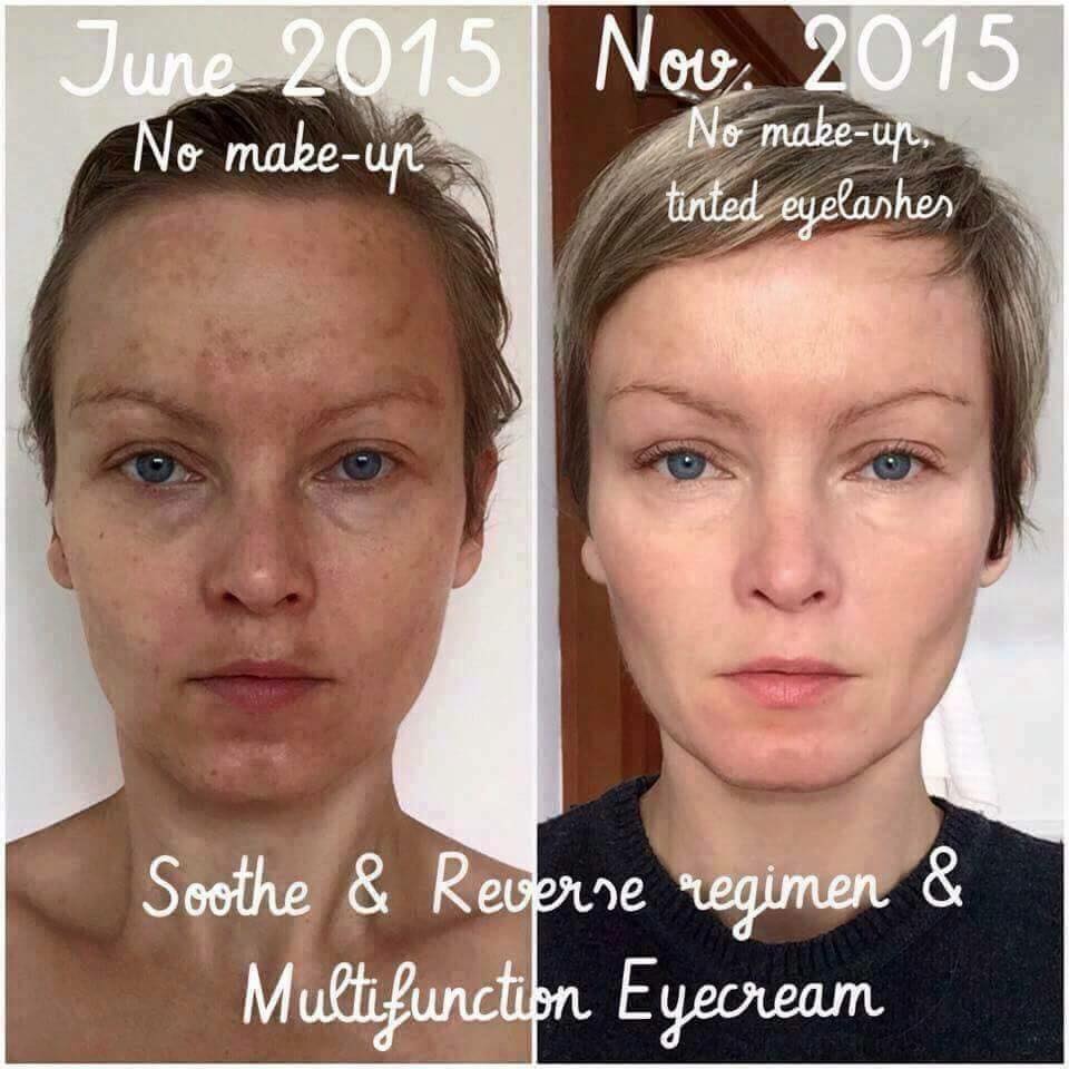 Healthy, Fit, and Focused: Sun Damage, Brown Spots, Uneven Skin Tone ...