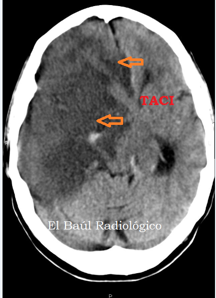 El Baúl Radiológico: ICTUS: UN GALIMATÍAS DE SIGLAS (Stroke: A ...