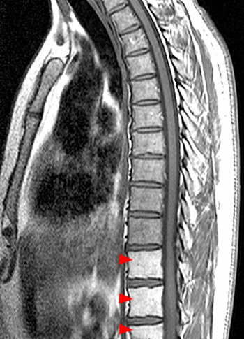 Radiology Pearls: MRI and Bone marrow