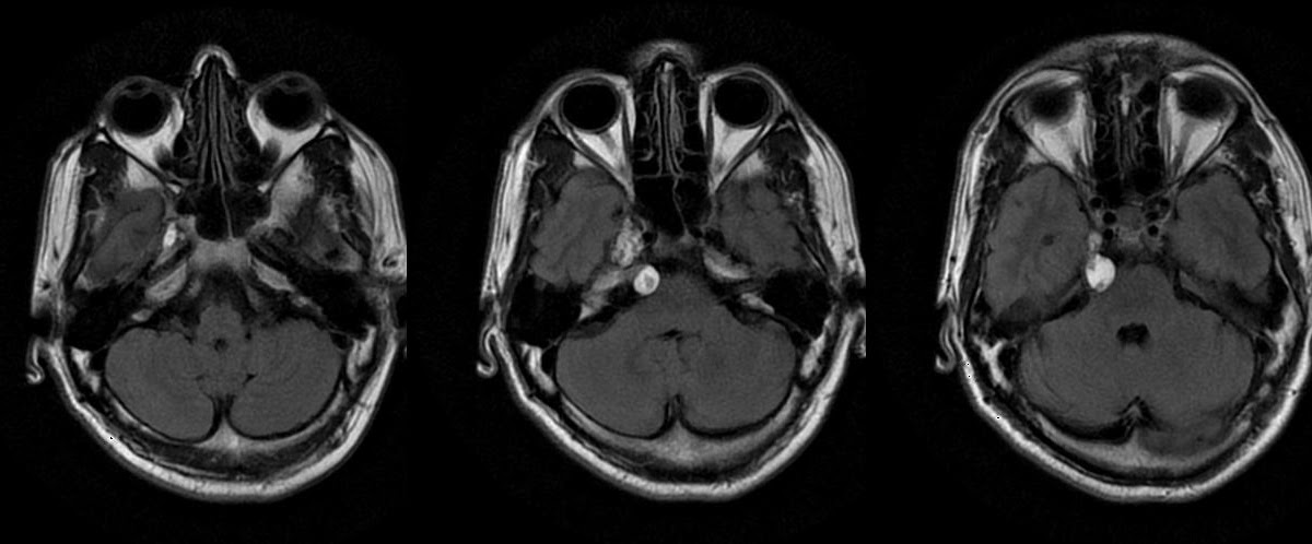 Neuroradiology Cases: Meckel's Cave Lipoma MRI