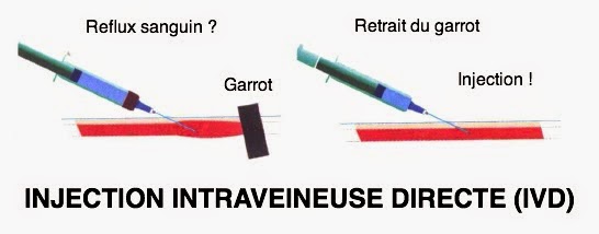 L'injection intraveineuse directe (IVD) | Récap' IDE