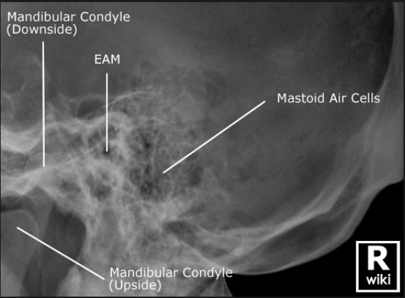 Teknik Radiografi: Teknik Radiografi Mastoid Dan Petrosum