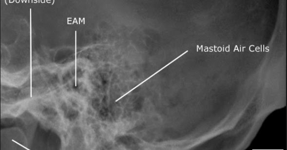 Teknik Radiografi: Teknik Radiografi Mastoid Dan Petrosum