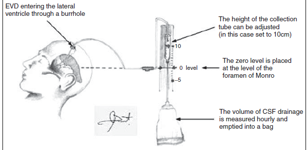 Liga Paraibana de Neurointensivismo: DERIVAÇÃO VENTRICULAR EXTERNA (DVE)