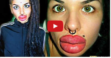 Jessica make world’s biggest lips by using Injection | NEWS