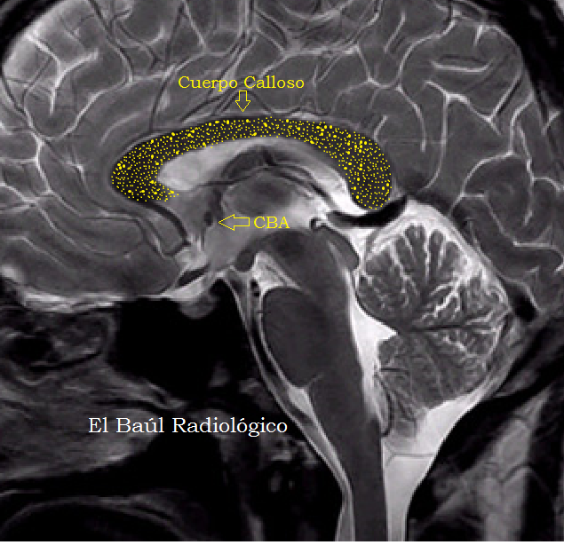 El Baúl Radiológico: EL CUERPO CALLOSO NORMAL. VARIANTES ANATÓMICAS ...
