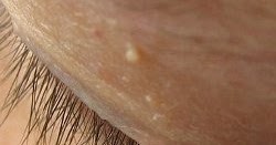 Moles Warts and Skin Tags Removal: FILIFORM WARTS