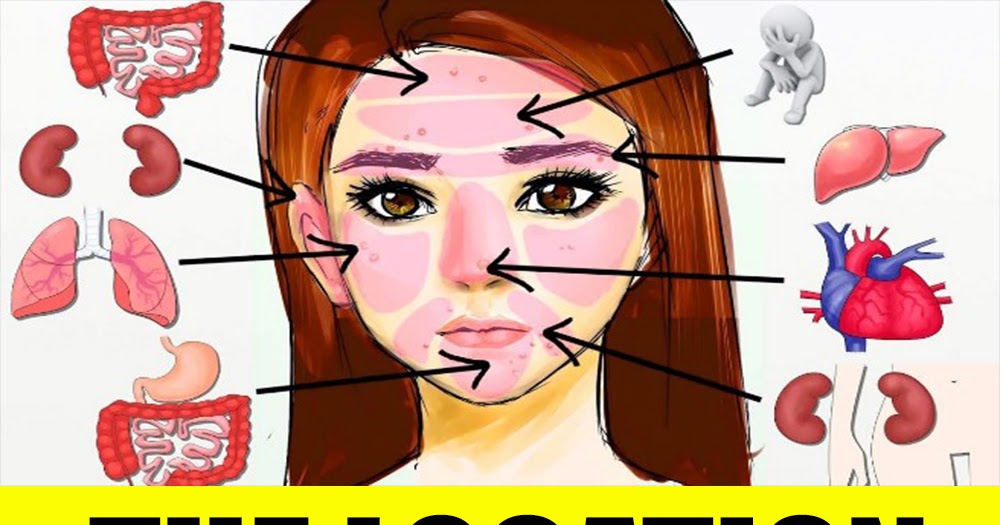 The Location Of Your Acne Can Tell A Lot About Your Health