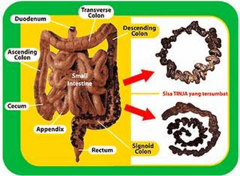DCL Agent ~ Pn. Anna Zahari Cantek: Bagaimana Mengenal Kanser Usus