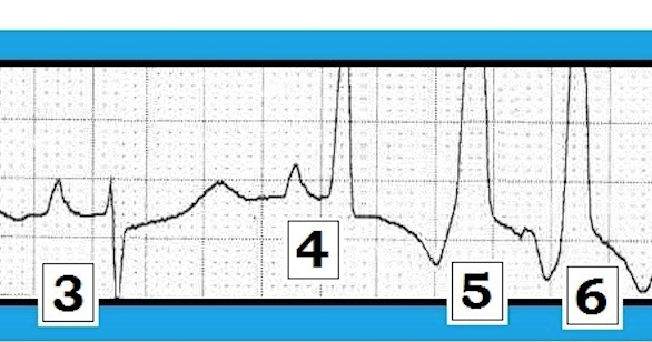 ECG Interpretation: ECG Blog #133 — Is there AV Dissociation?