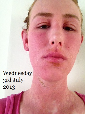 The many symptoms of withdrawal: Weeping skin | CARA-PACE