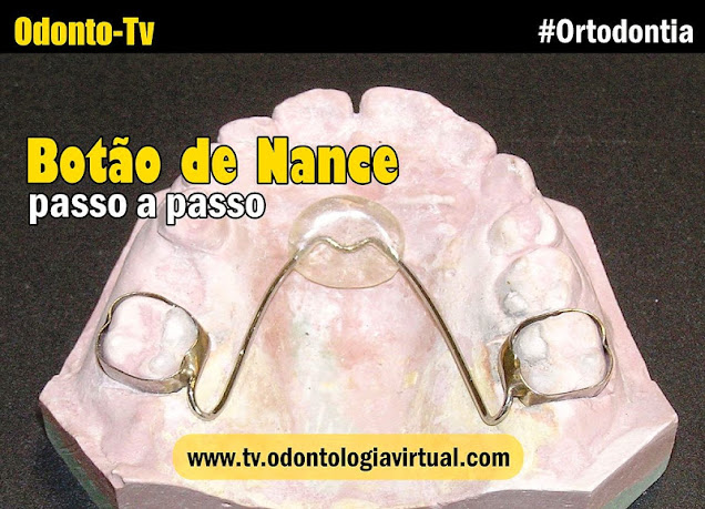 BOTÃO DE NANCE: Preparação passo a passo - Dr. Everton Flaiban