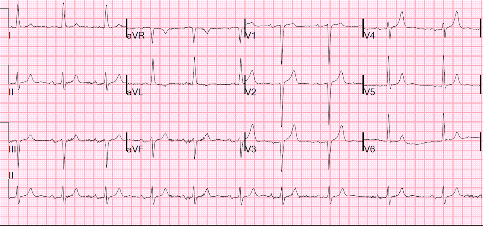 Dr. Smith's ECG Blog: Bradycardia