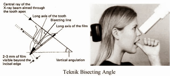 Teknik Radiografi Dental ~ Dent-ias || notes