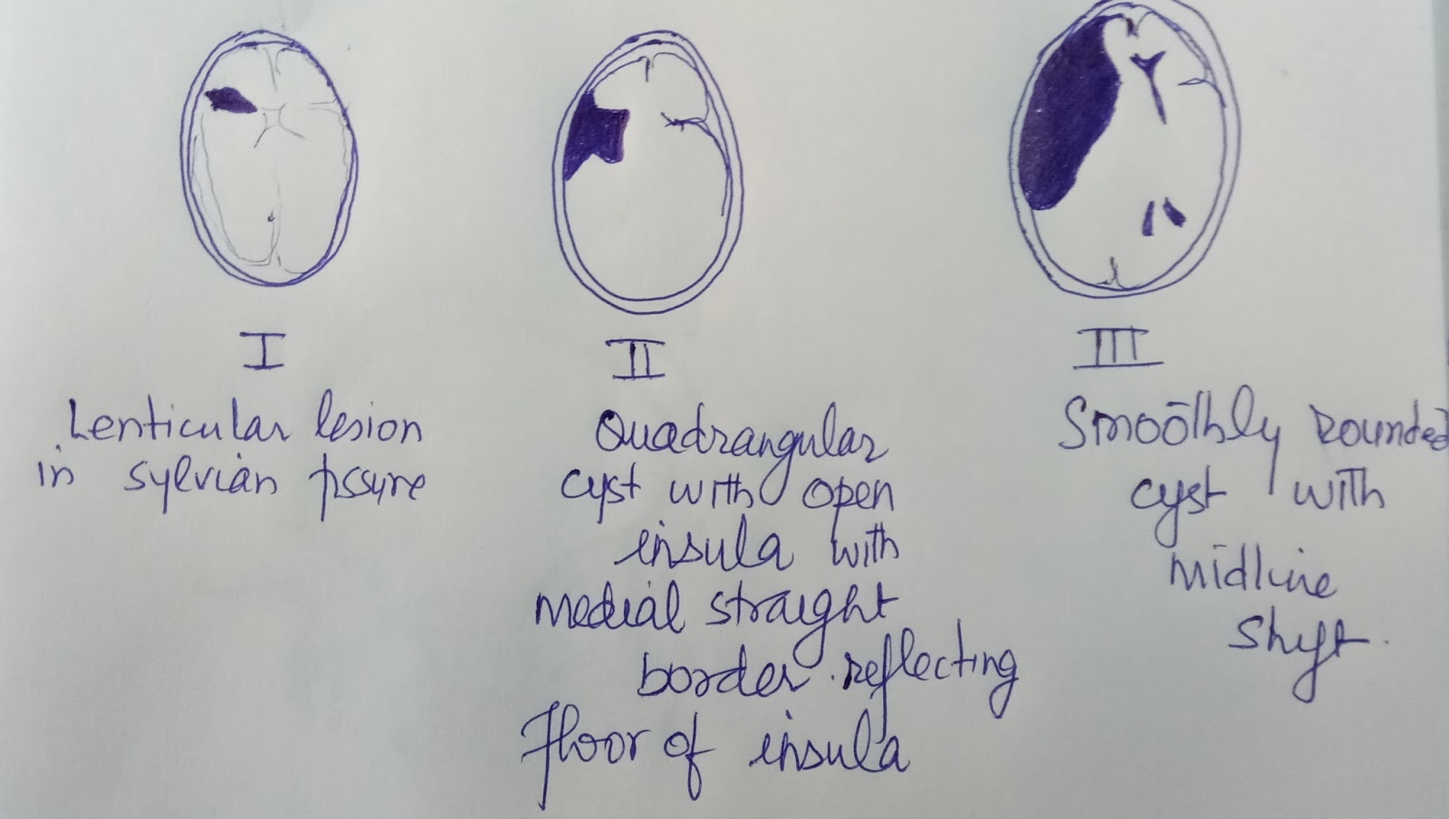 Brain & Mind - A to Z: Arachnoid cysts, Ependymal cysts, Benign ...