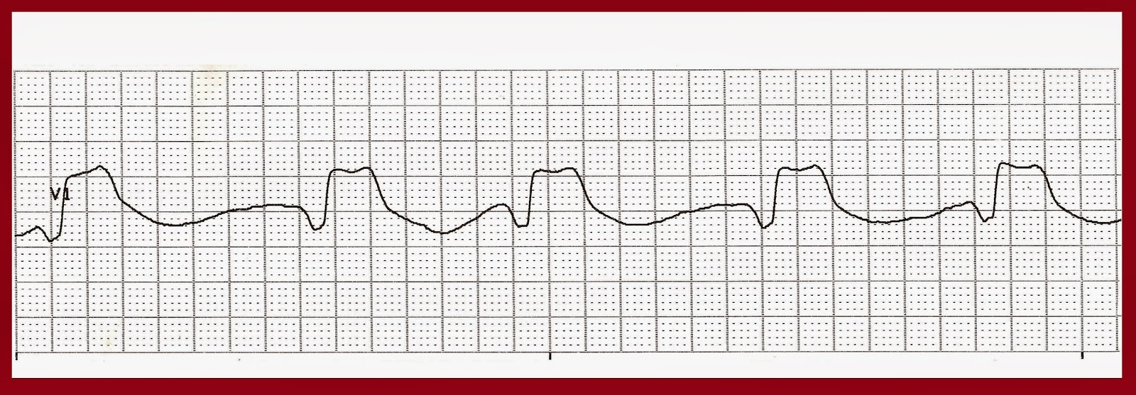 Various Accelerated Idioventricular Rhythms