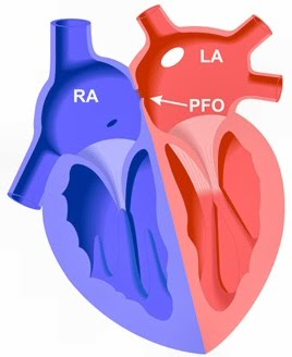 20% Humans have hole in their Heart - Patent Foramen Ovale (PFO)