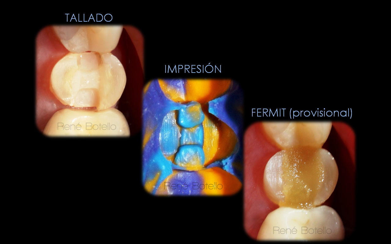 Máster en Odontología Restauradora y Endodoncia: Tratamiento de ...