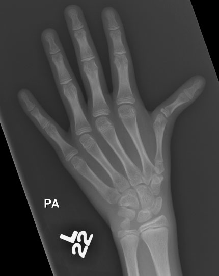 Small thumbs | Congenital Hand and Arm Differences | Washington ...