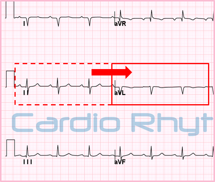 CVT Mohd Farid: ECG Basic:Cardiac Axis-Credit Cardio Rhythm Online Blogspot