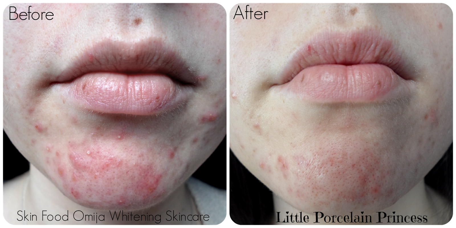 Treatment For Rosacea Pustules 7 Weeks