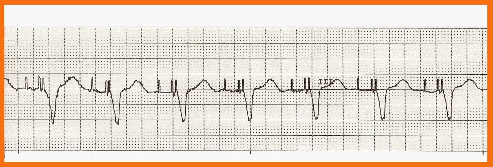 EKG Rhythm Strip Quiz 215