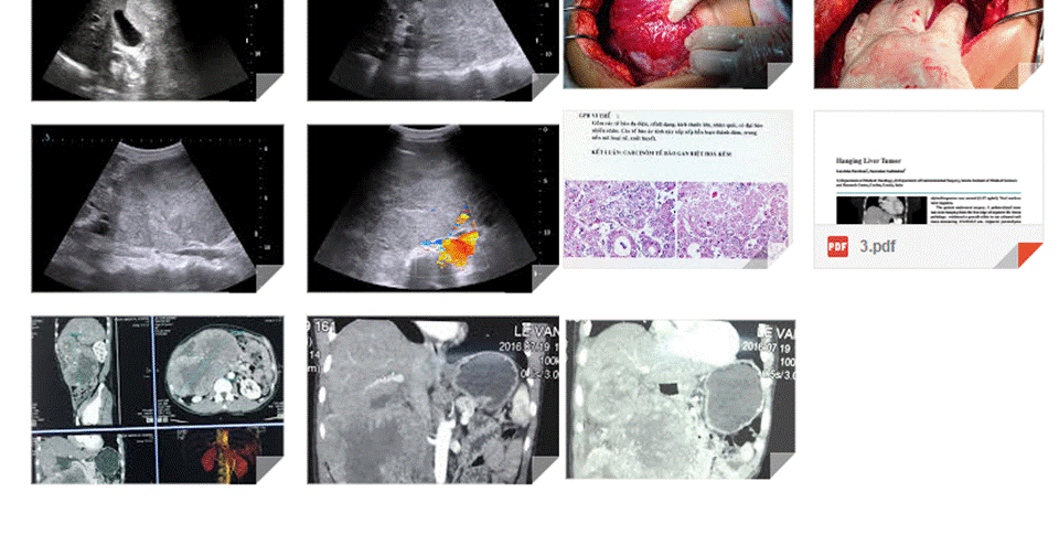 VIETNAMESE MEDIC ULTRASOUND: CASE 390: PEDUNCULATED HCC, Dr PHAN THANH ...