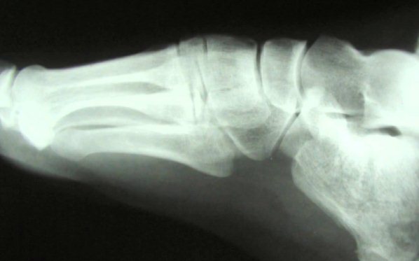 Stage 4 Bone Cancer Survival Rates stage-4-bone-cancer-survival-rates