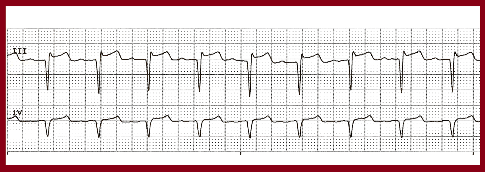 Various First Degree Heart Blocks