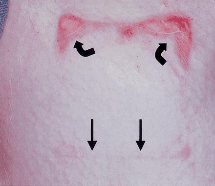 Threshold Electrical Stimulation (TES) in Paediatric Neurological ...