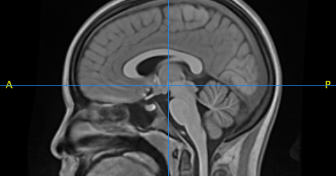 Making a Brain Template