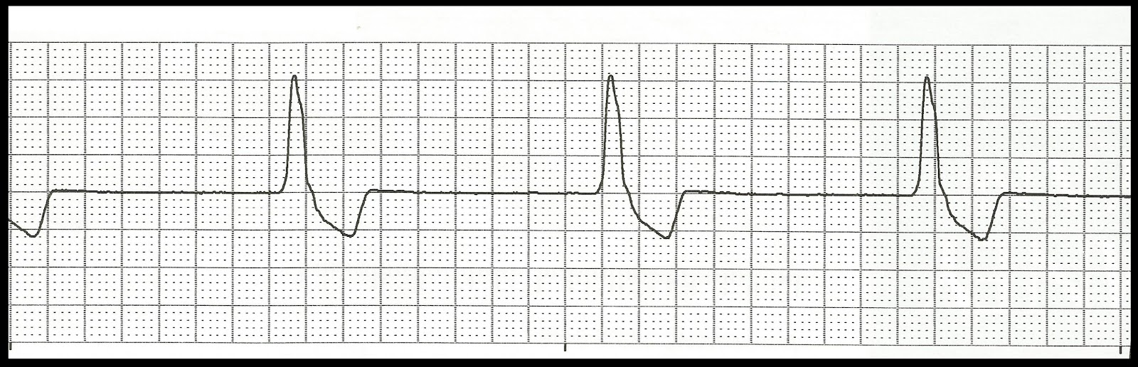 Practice EKG Rhythm Strips 140
