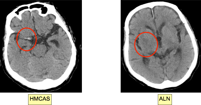 Hospitalist ~病院総合診療医~: 脳梗塞: 画像診断