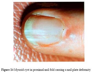 Nail Diseases: Longitudinal Grooves