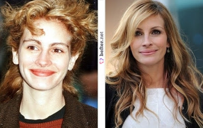 Julia Roberts Plastic Surgery Before and After Nose Job and Facial ...