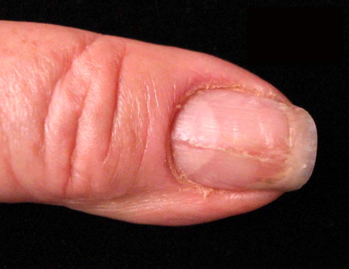 VIRTUAL GRAND ROUNDS IN DERMATOLOGY 2.0: Two Patients with Longitudinal ...